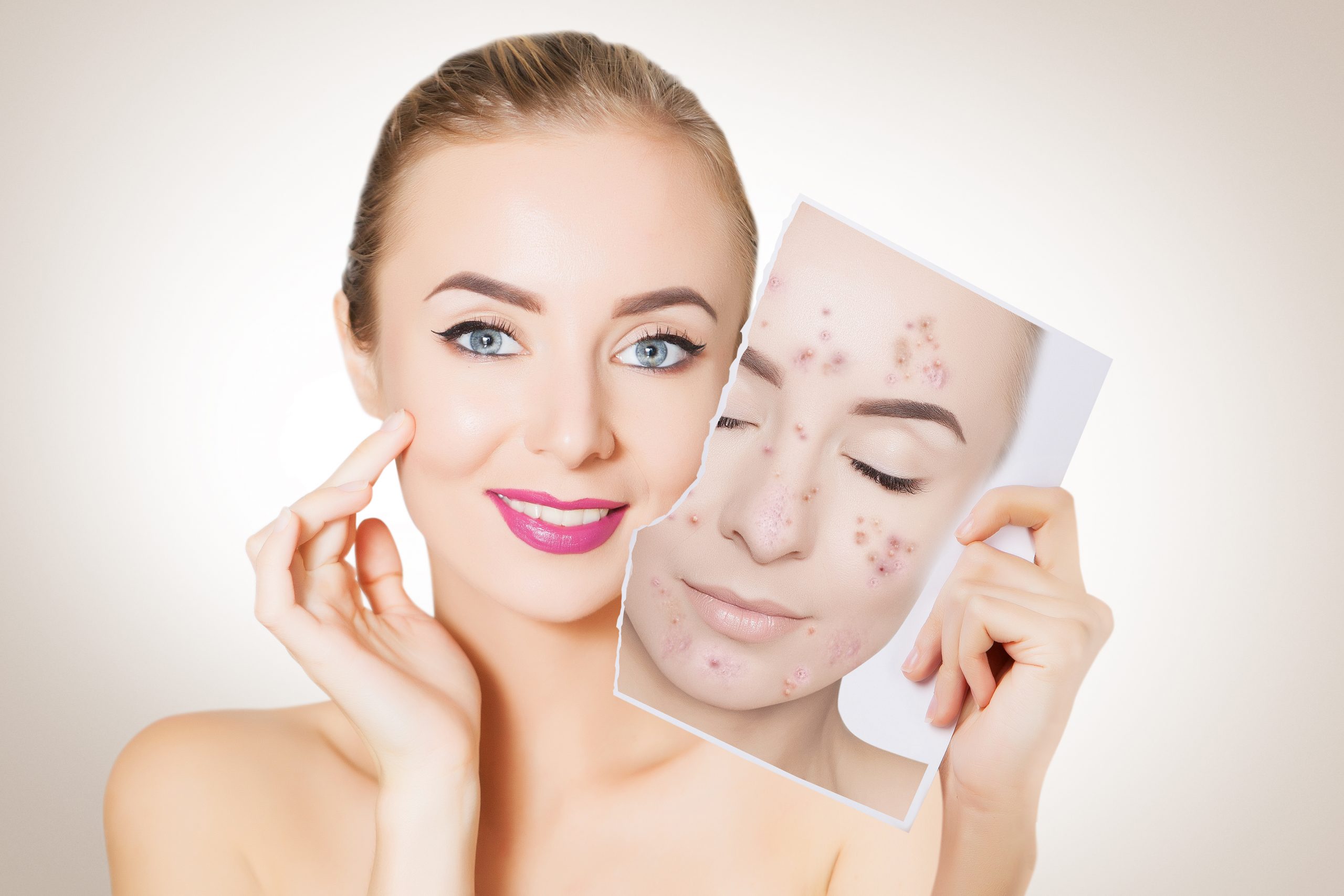 Managing Winter Acne - egskinclinic