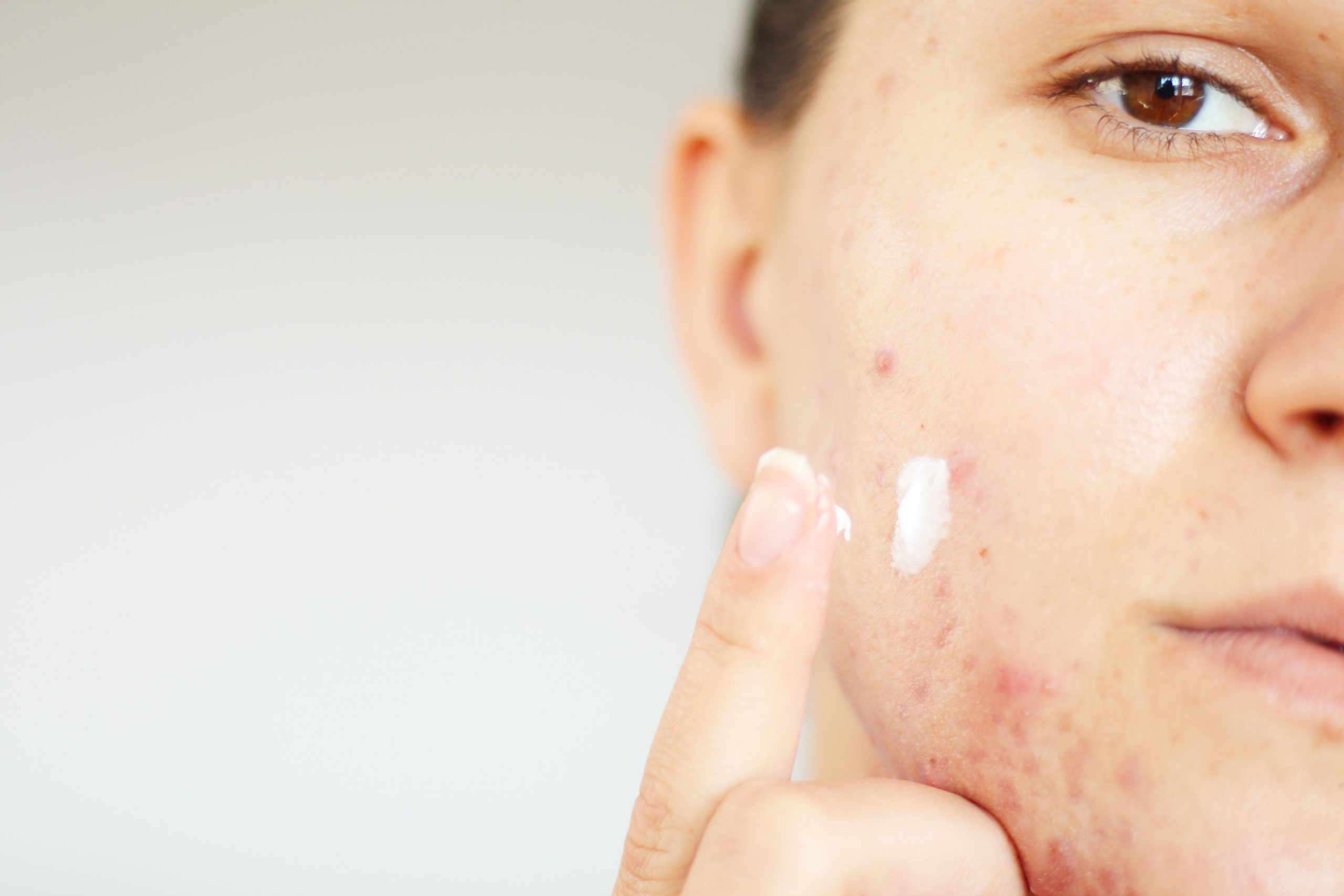 Preventing and treating Winter Acne - egskinclinic