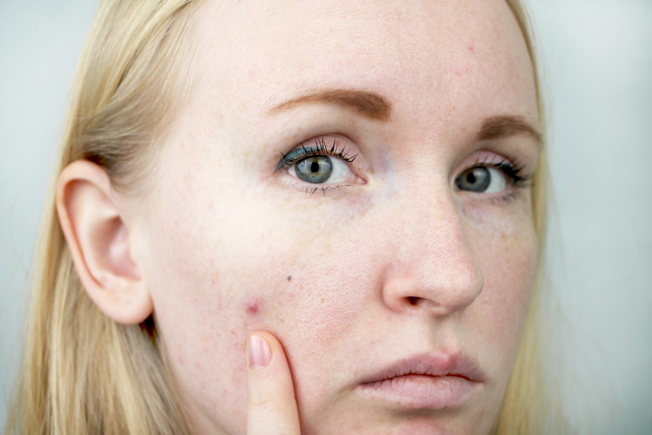 Understanding Adult Acne - egskinclinic